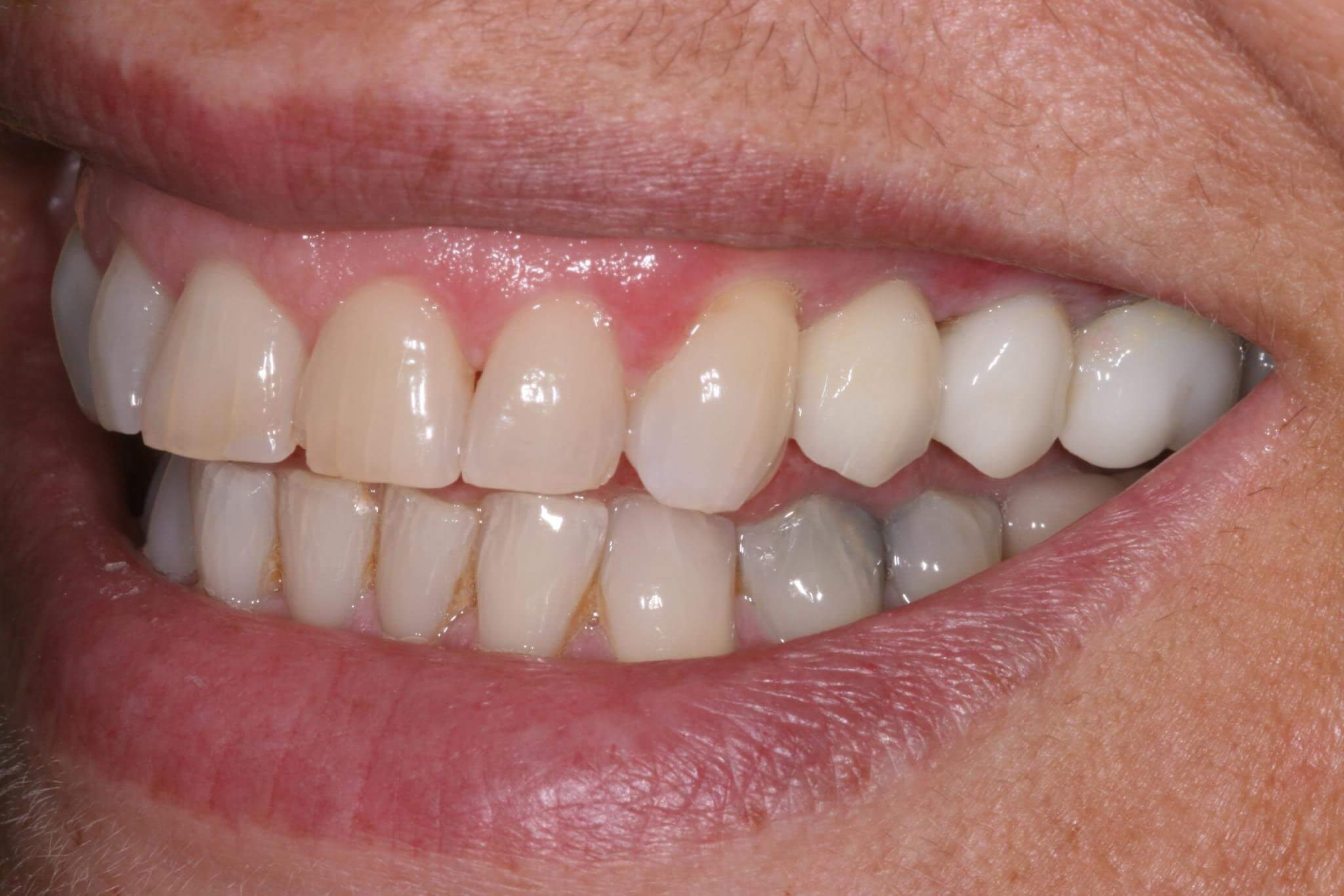 Replace Missing Teeth Wickham | Wickham Dental Practice