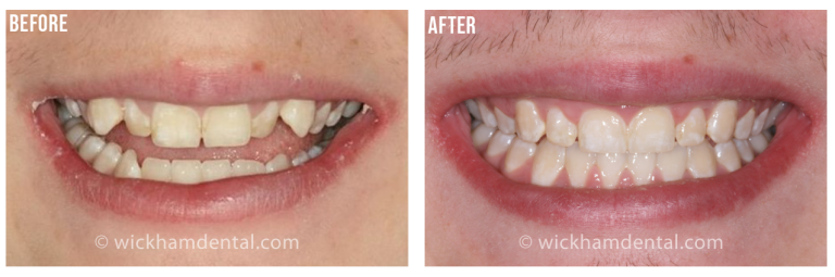 Dental Smile Gallery | Wickham Dental Practice