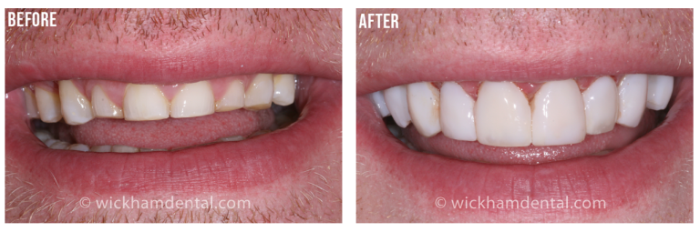 Dental Smile Gallery | Wickham Dental Practice